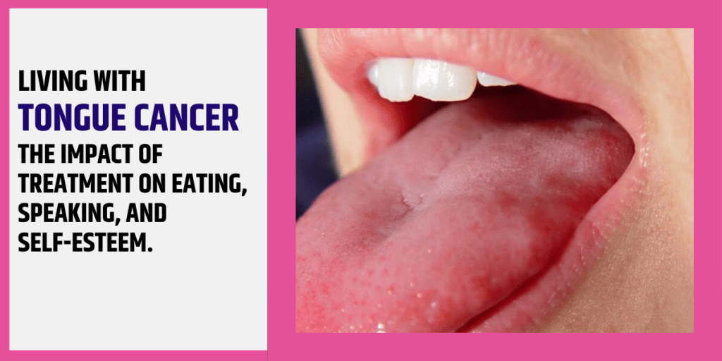 Living with Tongue Cancer: The Impact and of Treatment on Eating ...