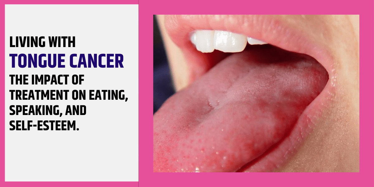 Tongue Cancer Prevention